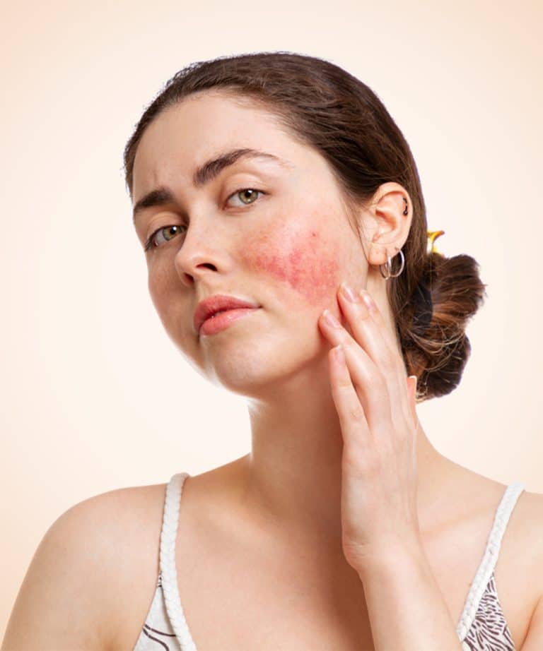 Treating Rosacea in Frisco, TX | Rodgers Dermatology